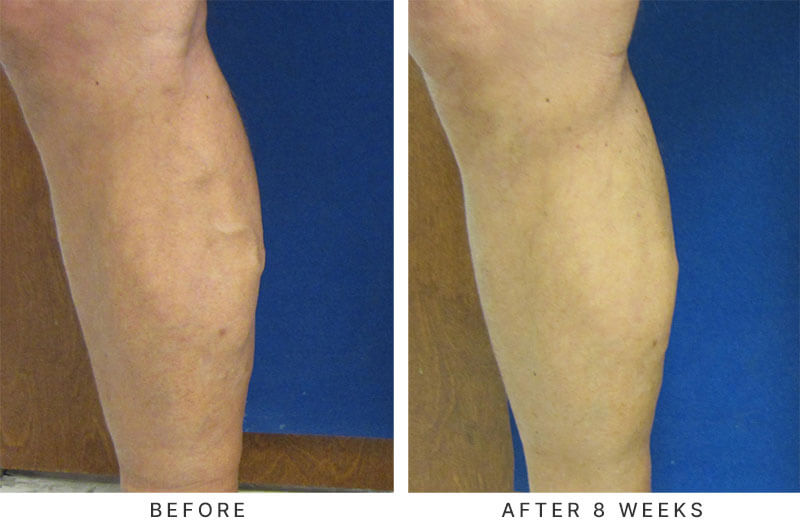 Before After Community Vein Care